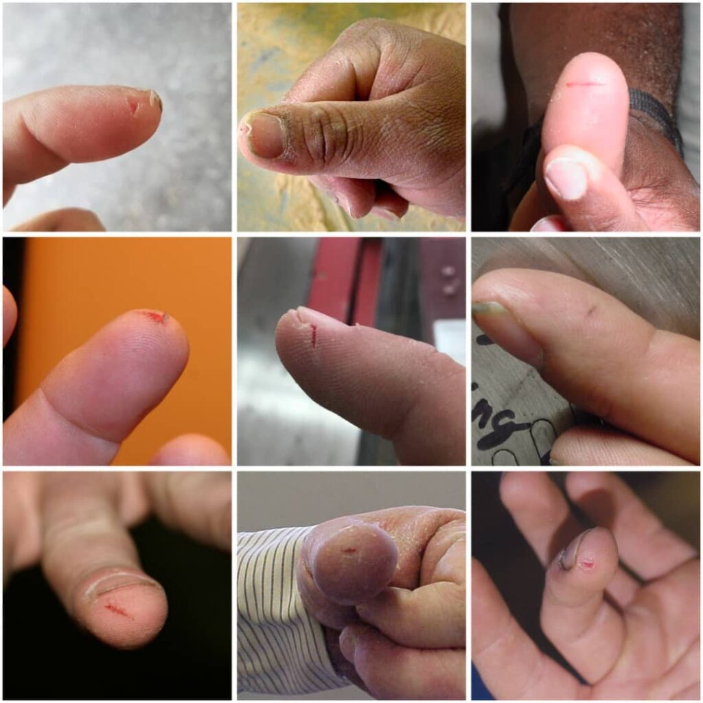 Is a SawStop Worth It? The Shocking Injury Statistics That Will Make ...